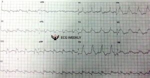 A Decade of ECG Gems: The Final 5 Favorite Cases – ECG Weekly