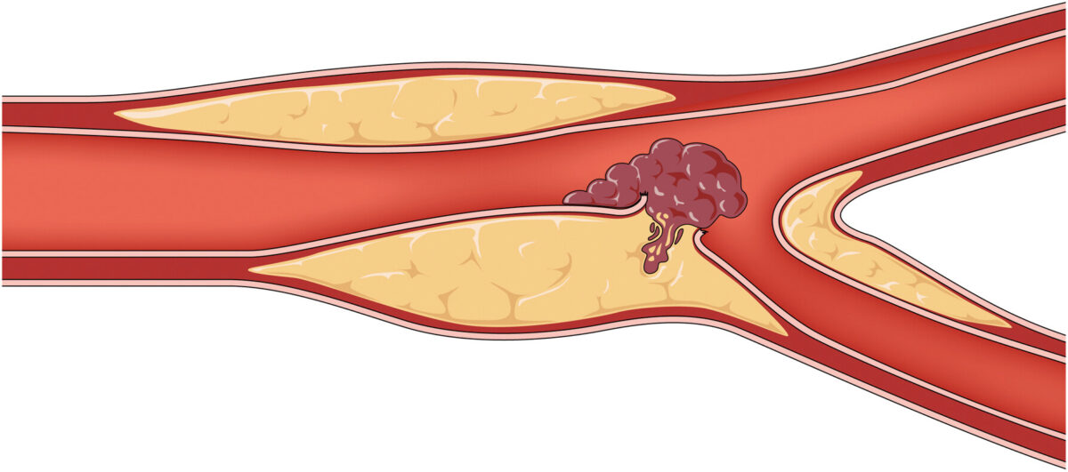 EMS ECGs in Acute Coronary Syndromes (ACS) – ECG Weekly