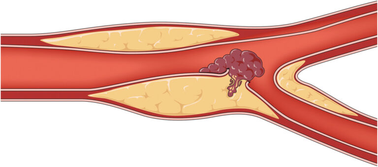 EMS ECGs in Acute Coronary Syndromes (ACS) – ECG Weekly