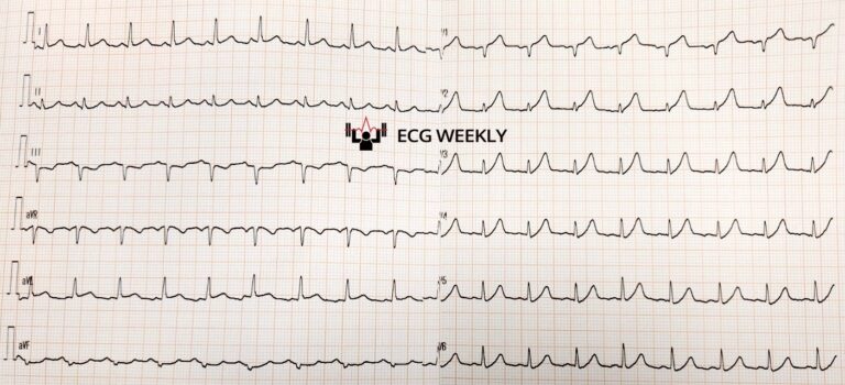 Hyperacute T Waves: Distinguishing Early MI from Other Big T Wave ...