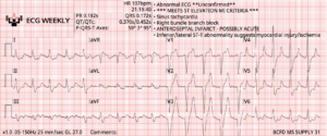 ECG Weekly – Mastering ECG Interpretation To Save And Improve More Lives