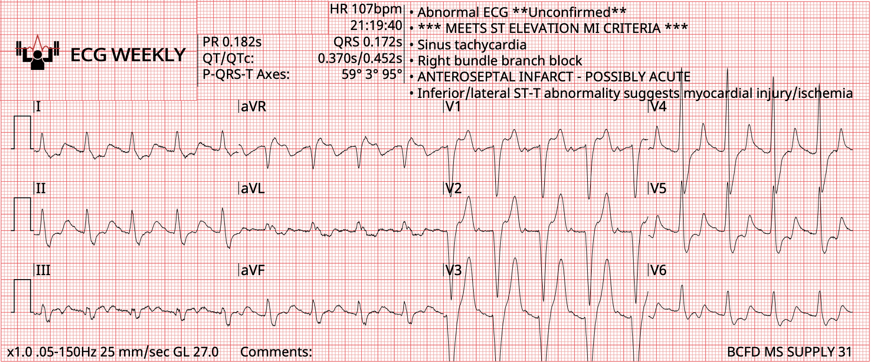ECG Weekly – Mastering ECG Interpretation To Save And Improve More Lives