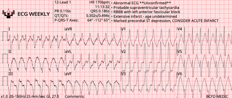 ECG Weekly – Mastering ECG Interpretation To Save And Improve More Lives