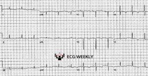 Unrecognized Killers in Emergency Electrocardiography, Part II – ECG Weekly