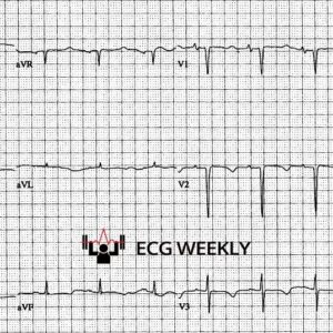 Polymorphic Ventricular Tachycardia – ECG Weekly