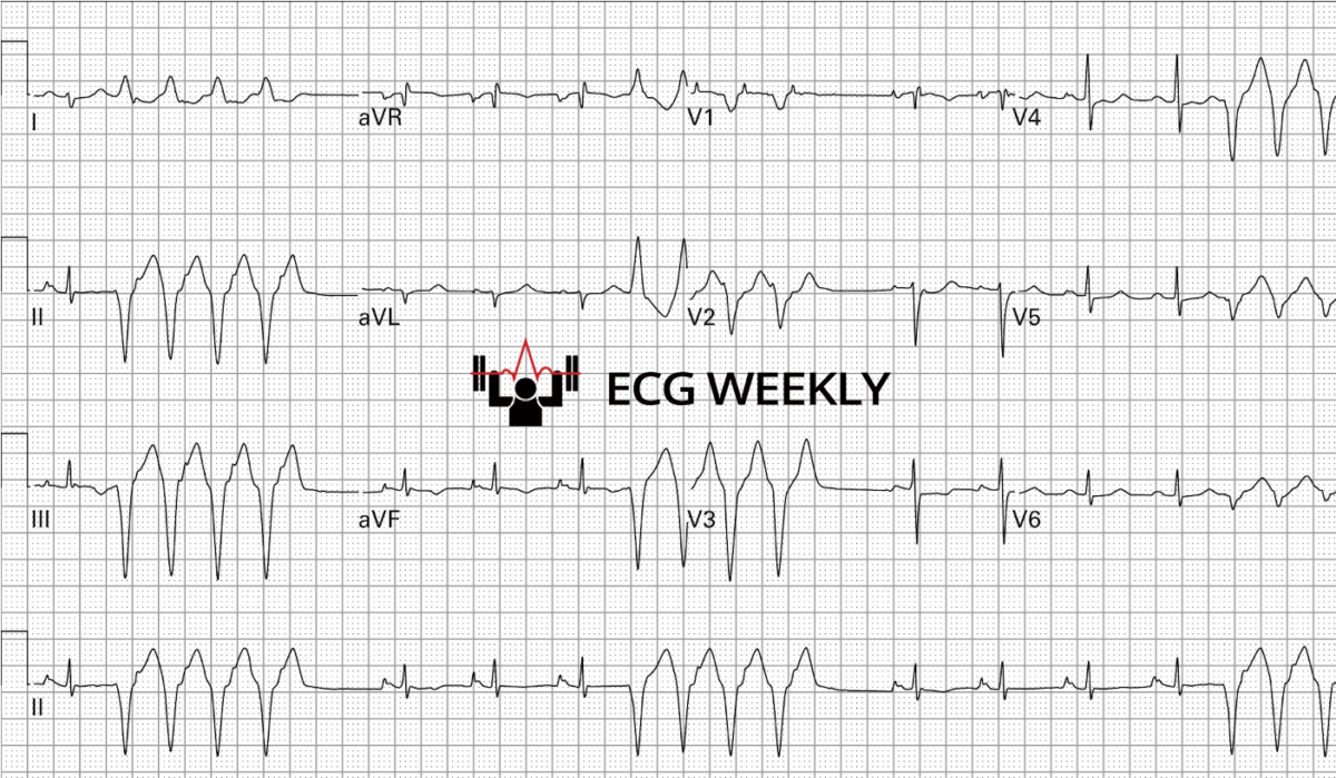 Optical Illusions and 12-Lead ECGs: How First Impressions Can Mislead ...