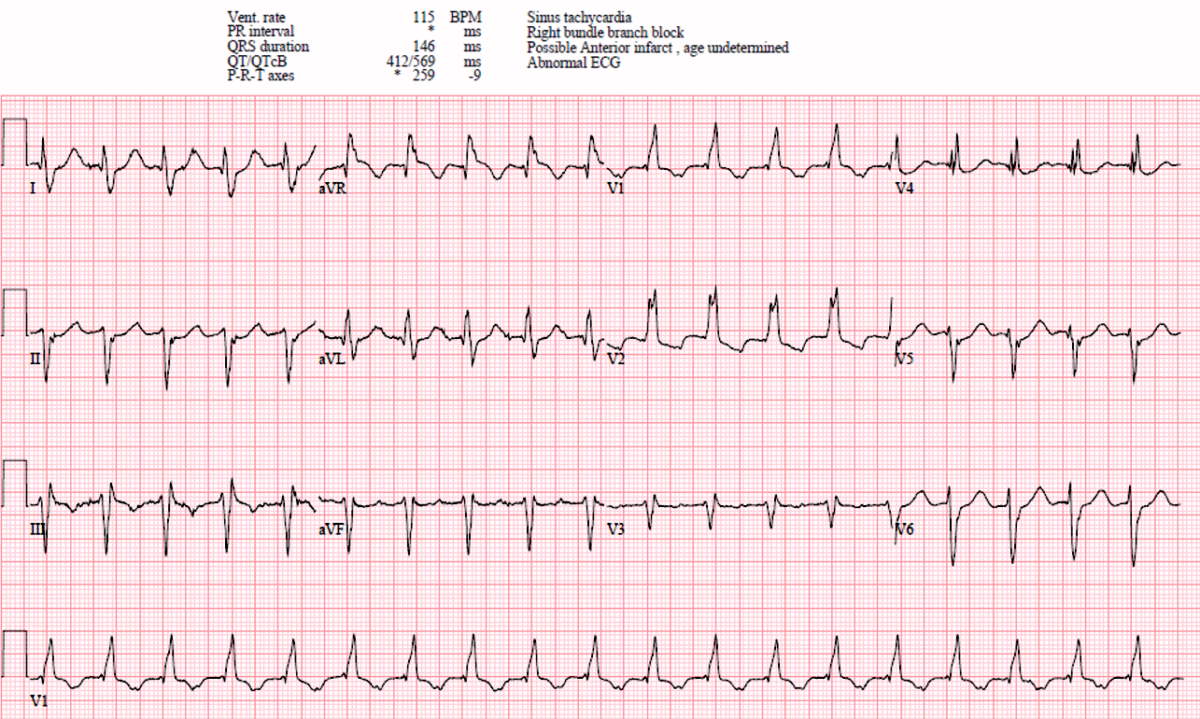 Recent University of Maryland Medical Center Cases (Part I) – ECG Weekly