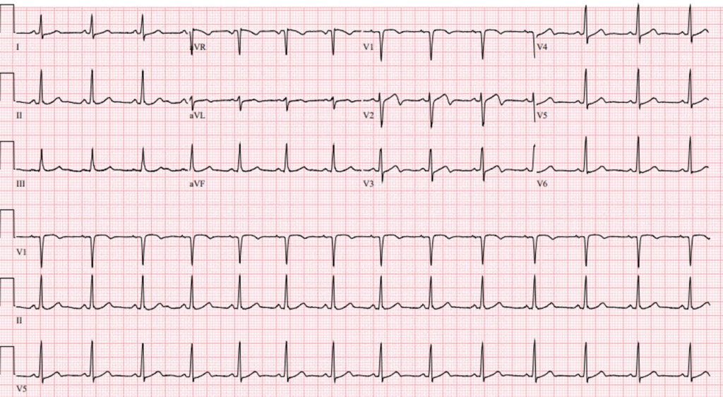 Recent University of Maryland Medical Center Cases (Part II) – ECG Weekly