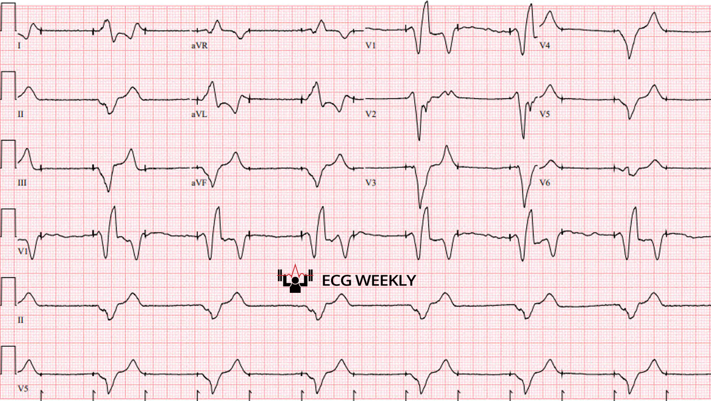 ECG Weekly – Mastering ECG Interpretation To Save And Improve More Lives
