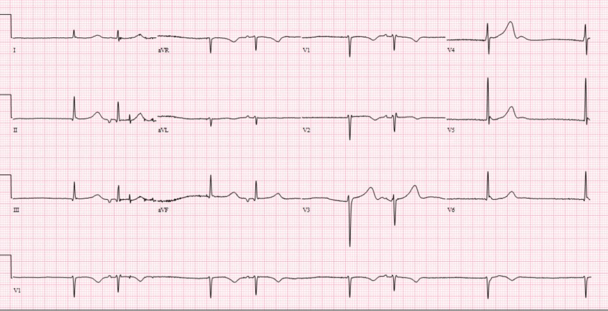 2025 ECG Competition Answers (Part 3/3) – ECG Weekly