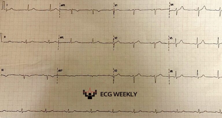 Small ECG Changes, Big Clinical Wins: How Repeat ECGs Save Lives – ECG Weekly