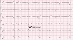 Mobitz I or Mobitz II: How to tell the difference – ECG Weekly