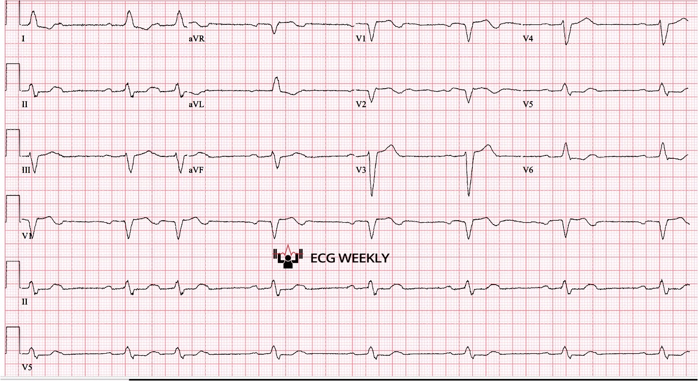 Mobitz I or Mobitz II: How to tell the difference – ECG Weekly