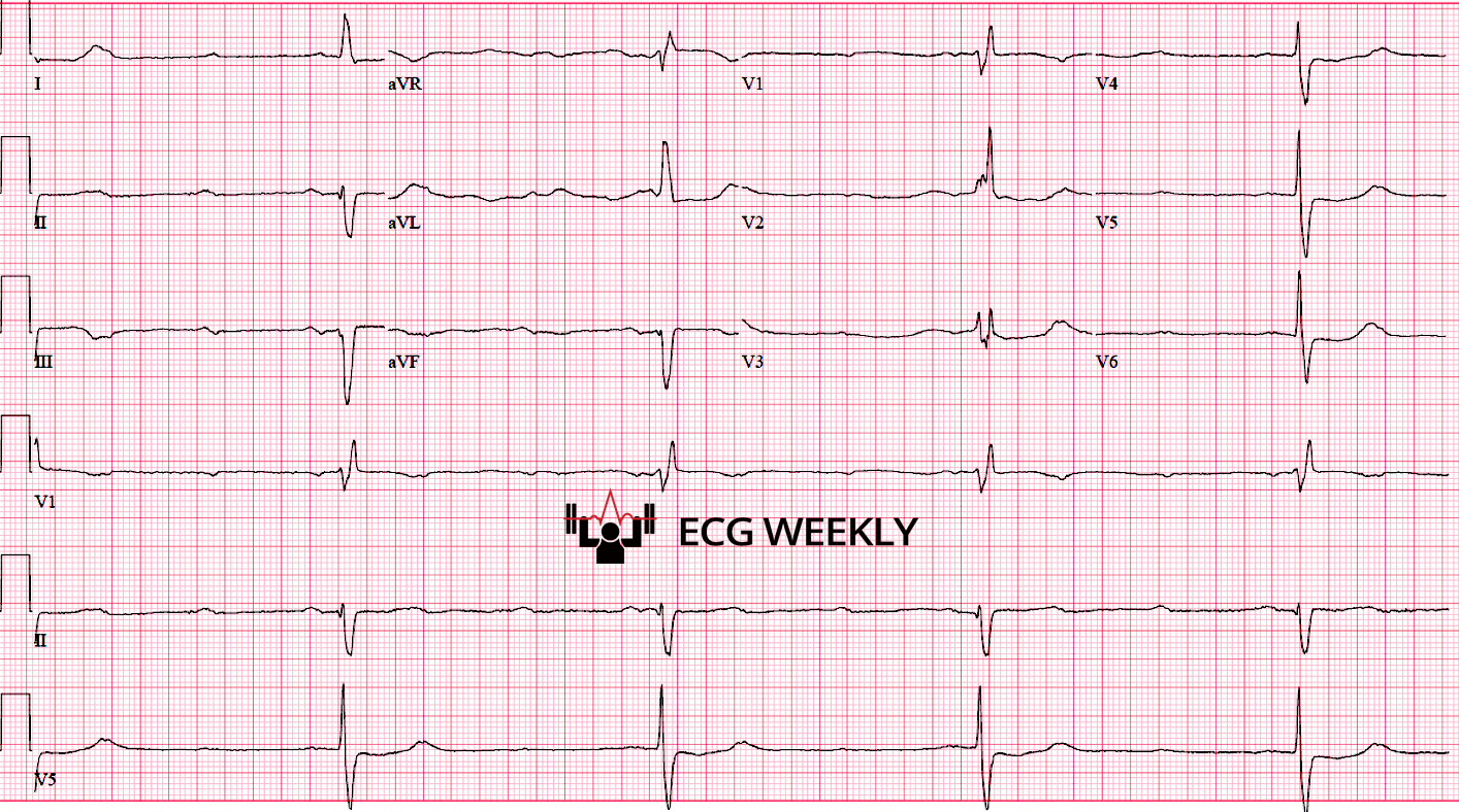 ECG Weekly – Mastering ECG Interpretation To Save And Improve More Lives