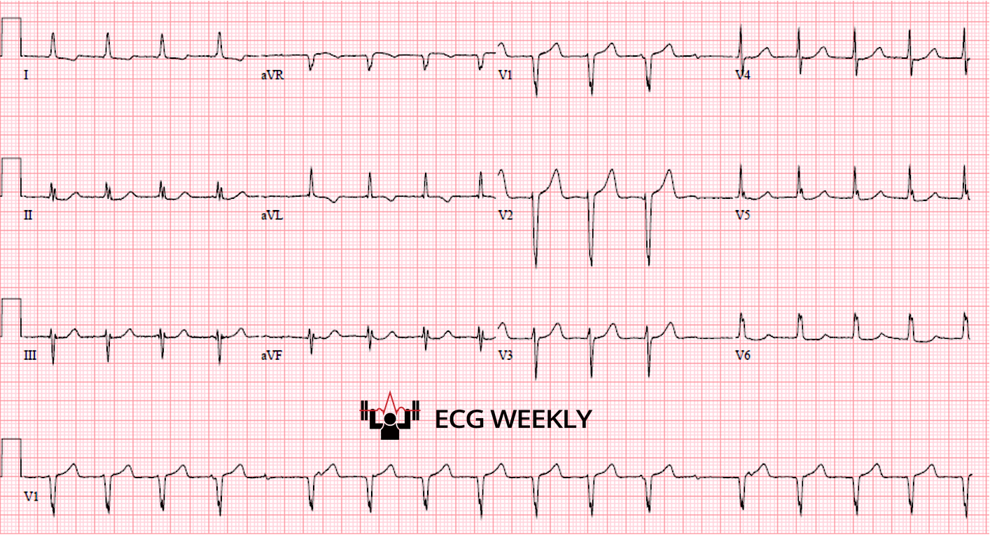 Grouped Beats: A Subtle AV Block Pitfall – ECG Weekly