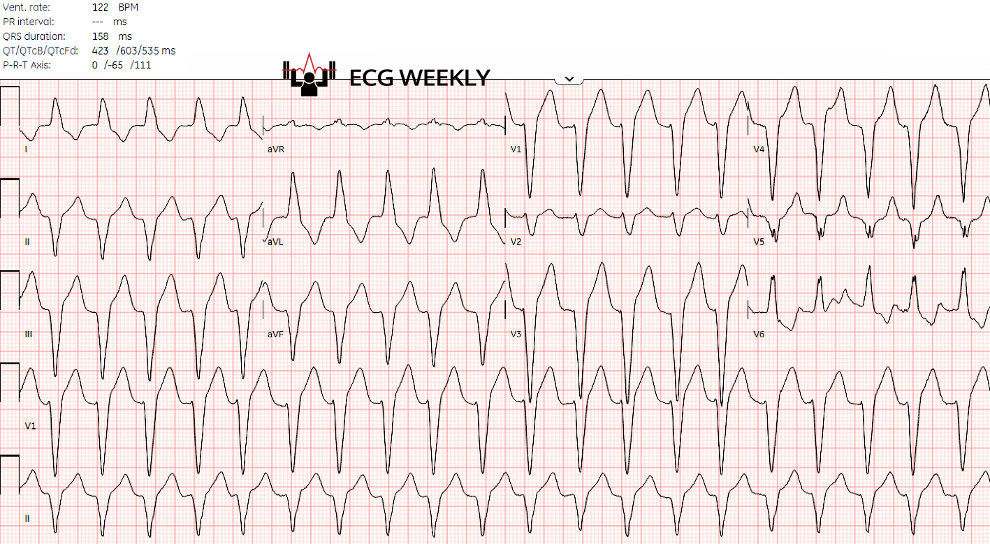 When to Default to VT and When to Doubt It – ECG Weekly
