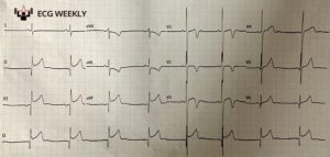Not Your Usual STEMI: High Voltage and Narrow Q Waves – ECG Weekly