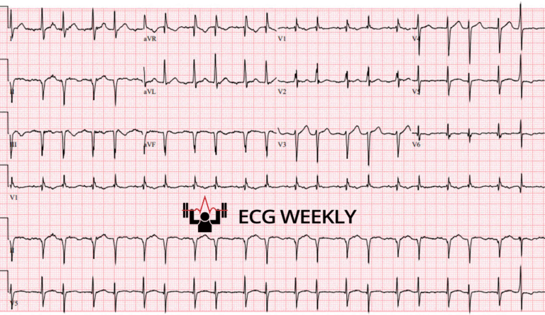 AFib Overdiagnosis: Dangerous Pitfalls and Safer Reads – ECG Weekly