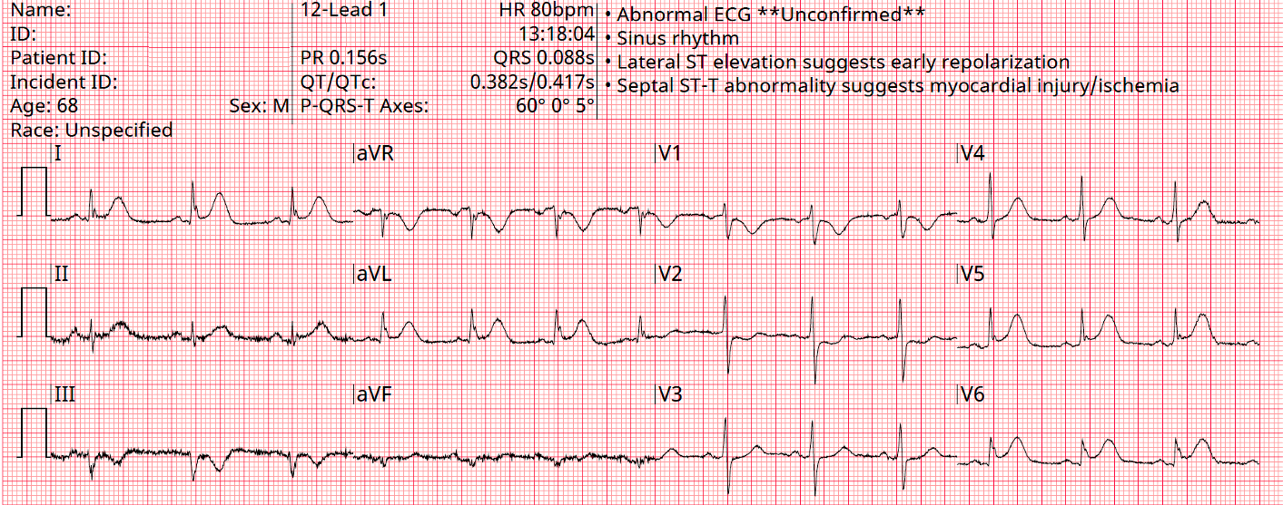 ECG Weekly – Mastering ECG Interpretation To Save And Improve More Lives