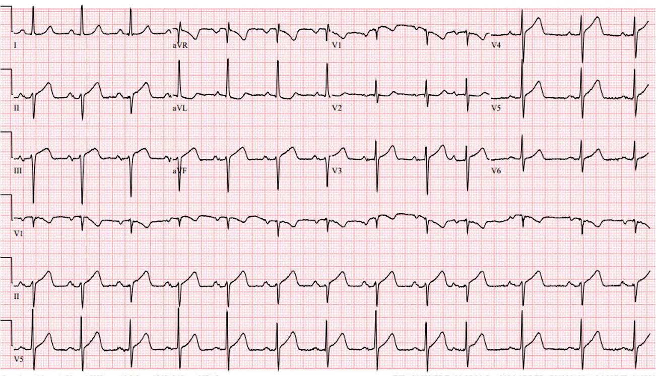 ECG Weekly – Mastering ECG Interpretation To Save And Improve More Lives
