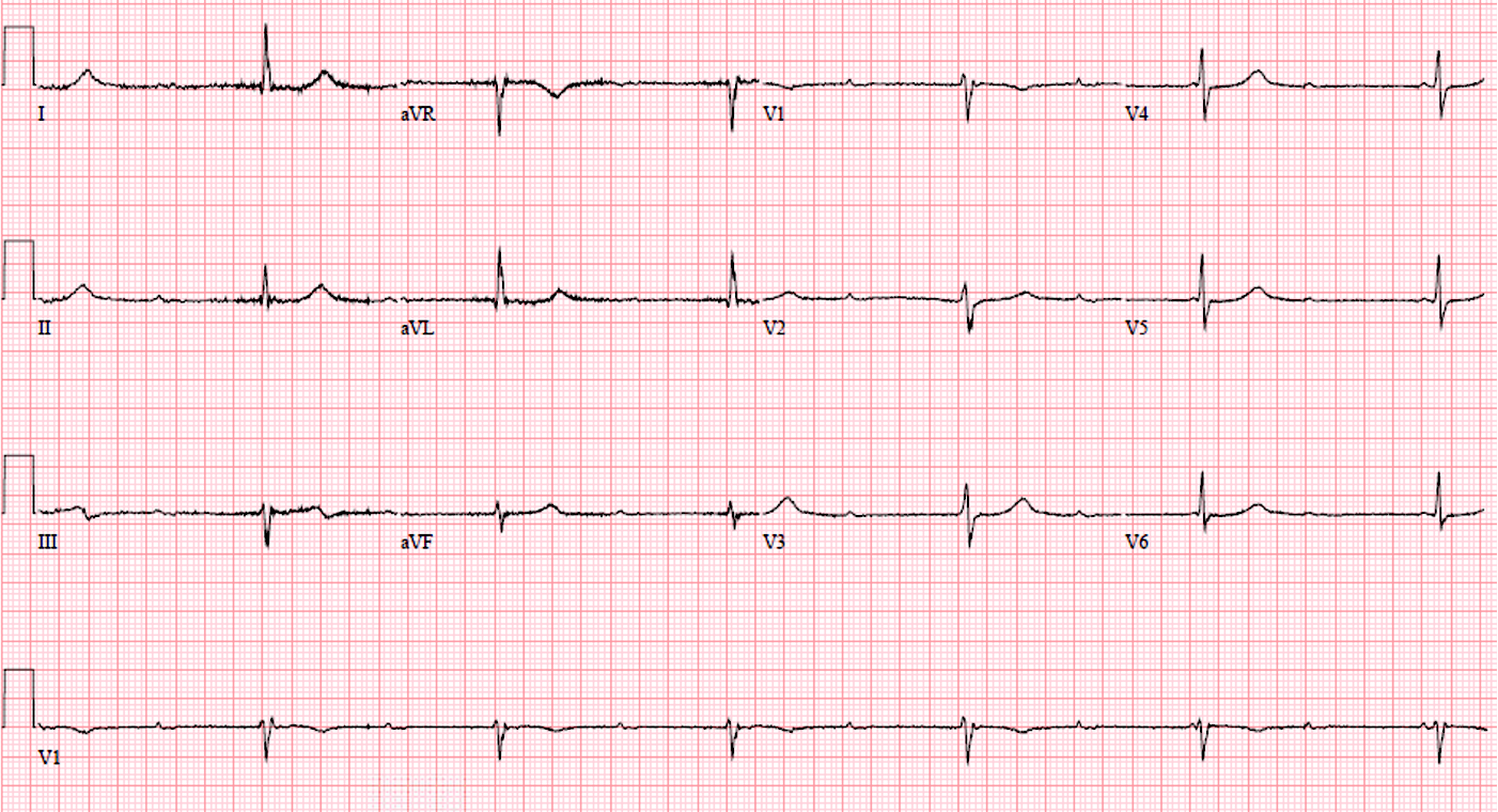 ECG Weekly – Mastering ECG Interpretation To Save And Improve More Lives